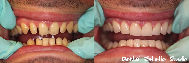 Zahnveneers in Kroatien Zagreb | Zahnart Dental Estetic Studio
