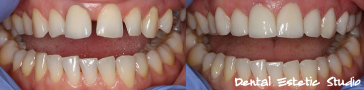 Zahnveneers in Kroatien Zagreb | Zahnart Dental Estetic Studio