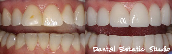 Zahnveneers in Kroatien Zagreb | Zahnart Dental Estetic Studio