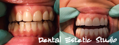 Zahnveneers in Kroatien Zagreb | Zahnart Dental Estetic Studio